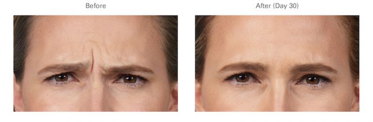Botox® Cosmetic in Avon, CT | Dr. Colleen Jambor